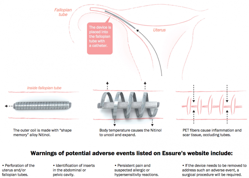 The Battle Over Essure - Type Investigations